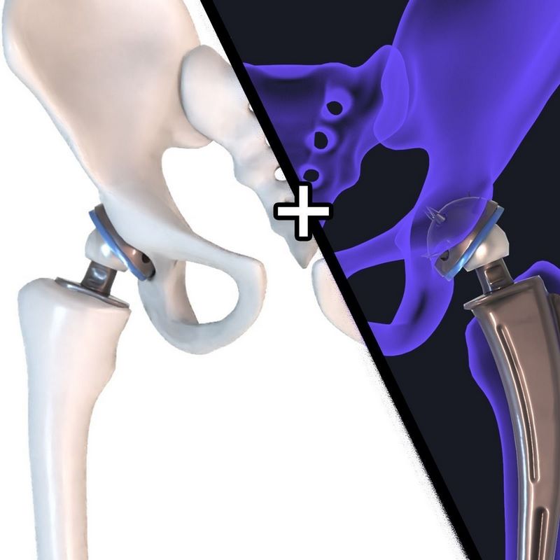 Desire FX 3d models | Hip replacement implant installed in the pelvis ...